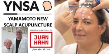YNSA – Yamamoto new scalp acupuncture by Juan Hahn